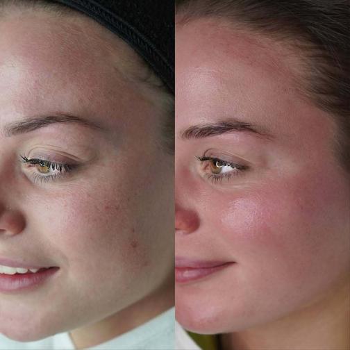 Glov Beauty PRX-INFUSION: Radiant Skin Transformation